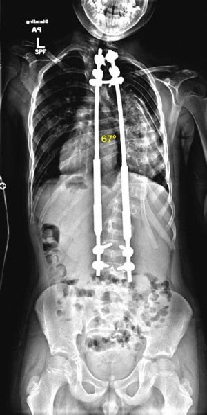 Scoliosis X Ray With Rods