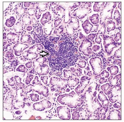 Sjogren Syndrome Basicmedical Key