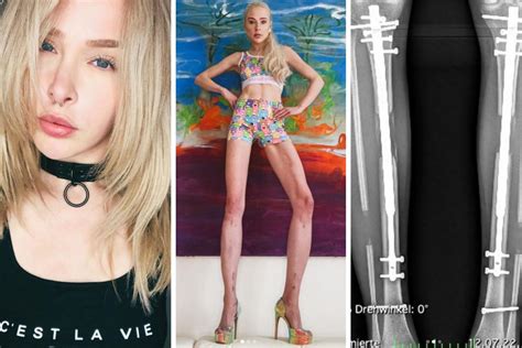 Gntm Model Theresia Fischer Lässt Beine Um 14 Cm Verlängern