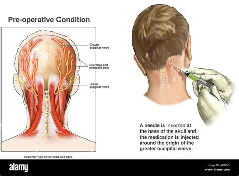Occipital Nerve Block Injection Stock Photo 7710002 Alamy