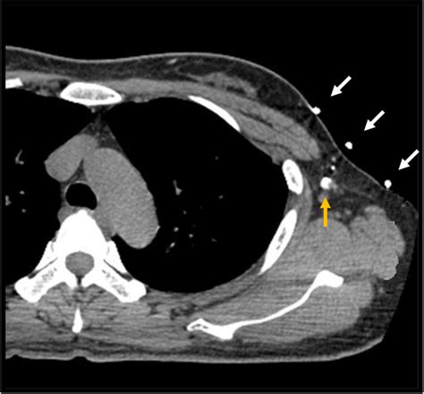 sentinel node yellow arrow identified by axial computed tomography download scientific