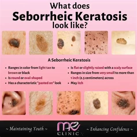 Actinic Keratosis Vs Seborrheic Keratosis Vujevich Dermatology Atelier Yuwaciaojp