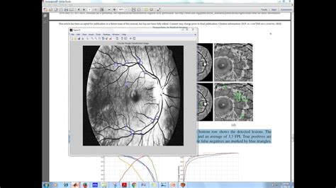red lesion detection using dynamic shape features for diabetic retinopathy ieee matlab projects