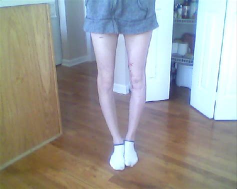 Bowed Legs On Tumblr