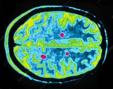 Col Mri Brain Scan Of A Multiple Sclerosis Patient Stock Image M210 440