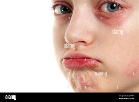 Allergic Reaction Skin Rash Close View Portrait Of A Girls Face Redness And Inflammation Of