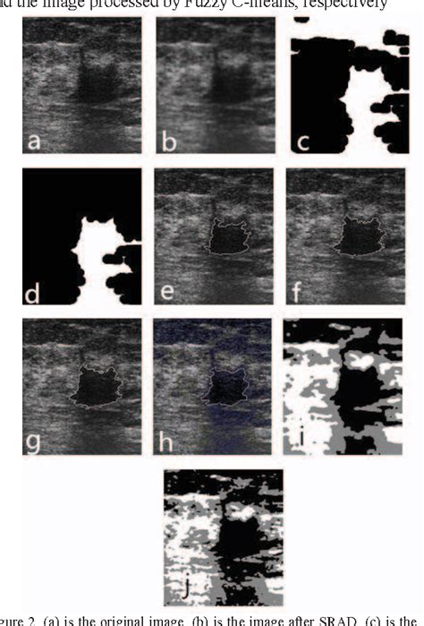 figure 1 from automatic segmentation algorithm of breast ultrasound image based on improved