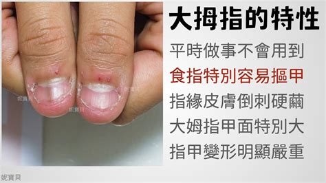 大拇指常見問題 甲溝炎 凹凸不平 歪斜變形 甲床分離 黑線白點