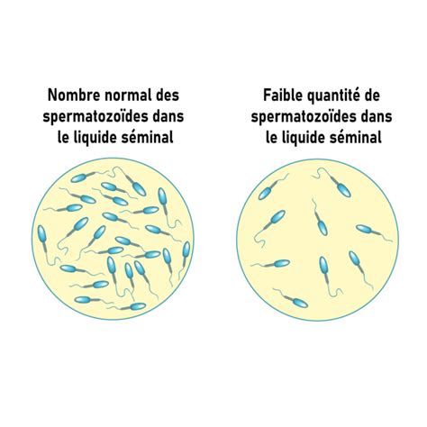 Spermogramme Déroulement Et Précautions à Prendre