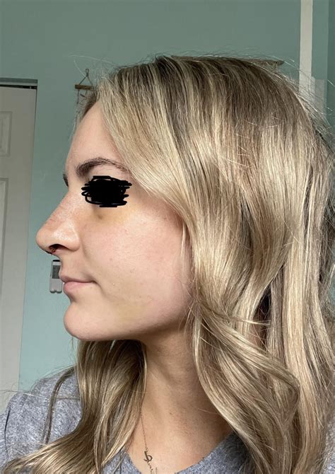Before And After Rhinoplasty Cast Removal Day Rplasticsurgery