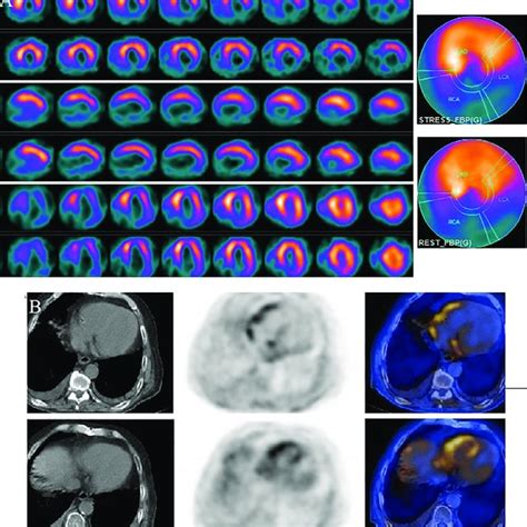 A Stress And Rest Myocardial Perfusion SPECT Short Vertical And