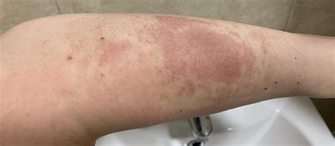What Might This Rash On My Forearm Be W Pictures Dermatologyquestions