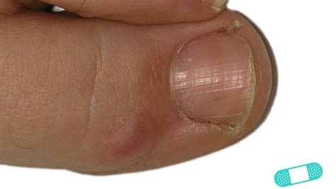Discover More Than 129 Bump On Finger Near Nail Super Hot Vn