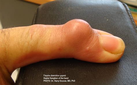 Ganglion Cyst StoryMD