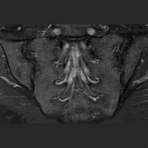 Mrt Isg Iliosakralgelenk Aristra Radiologie Netzwerk