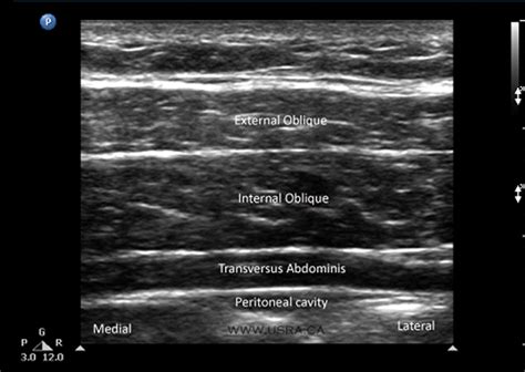 USRA Transversus Abdominis Plane TAP Block