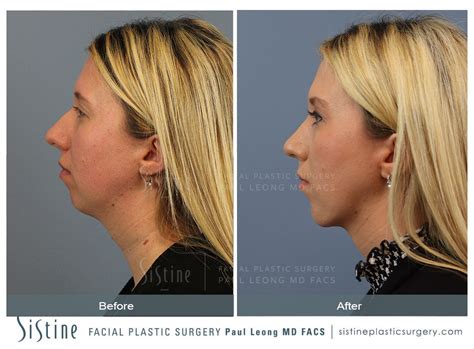 Chin Jaw And Neck Before And After 10 Sistine Facial Plastic Surgery