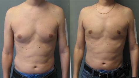 How To Tell If You Have Gynecomastia Youtube