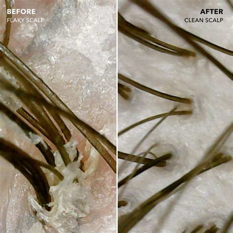 8 Types Of Scalp Folliculitis Ways To Get Rid Of Them Artofit