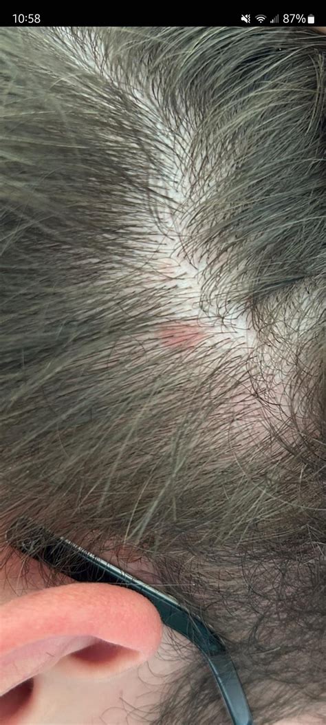 Red Spot On Scalp Rhair