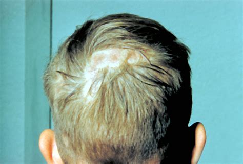 Public Domain Picture This Image Shows A Patient With Ringworm Of The Scalp Tinea Capitis