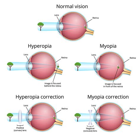 A Complete Guide To Refractive Errors Kingsbridge Opticians
