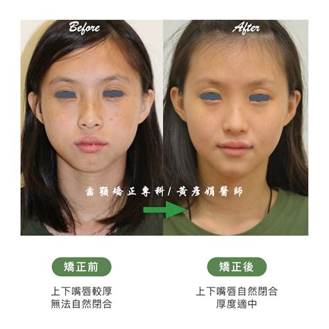 牙齒矯正案例 骨性暴牙 骨暴嘴凸 下顎後縮 逸澄美學牙醫