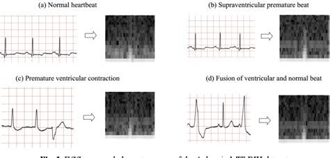 ecg heartbeat classification using deep transfer learning with convolutional neural network and
