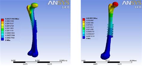 [pdf] finite element analysis of femur fracture fixation plates semantic scholar