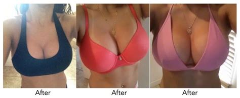 Breast Augmentation Breast Implant Breast Specialist Las Vegas