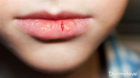 Eczema On Lips Lip Dermatitis Triggers And Best Treatment Dermeleve®