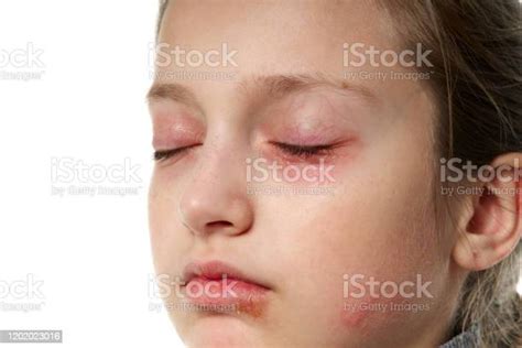 Allergic Reaction Skin Rash Close View Portrait Of A Girls Face Redness And Inflammation Of The