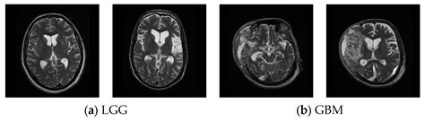 diagnostics free full text brain tumor class detection in flair t2 modality mri slices using