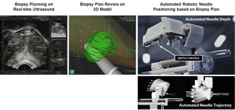 Dr Tim Nathan Urology Dr Tim Nathan Uses Advanced Biobot Robotic Prostate Biopsy System