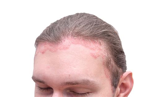 Red Spots On Scalp Pictures Causes And Treatments