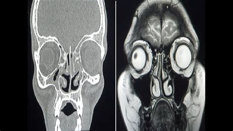 Ct Scan Vs Mri 4 Difference Between Ct Scan And Mri Physiosunit