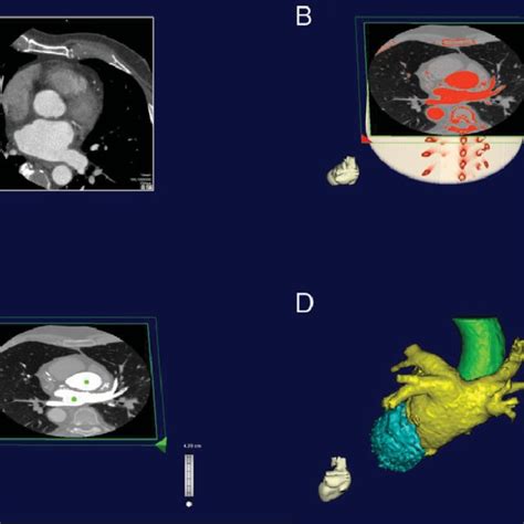 segmentation of a computed tomography ct dataset for image download scientific diagram
