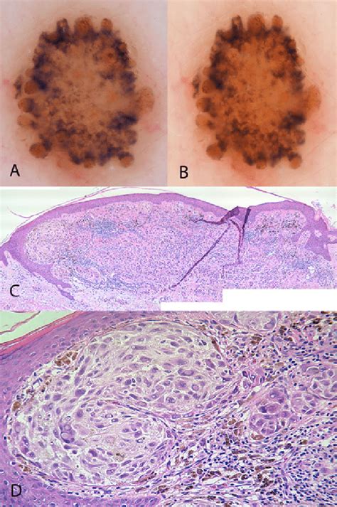 Case 5 A Non Polarized Dermatoscopic Image B Polarized