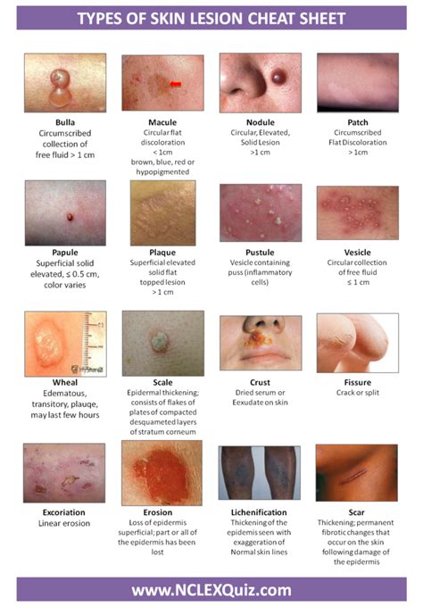 Types Of Skin Lesion Cheat Sheet Nclex Quiz