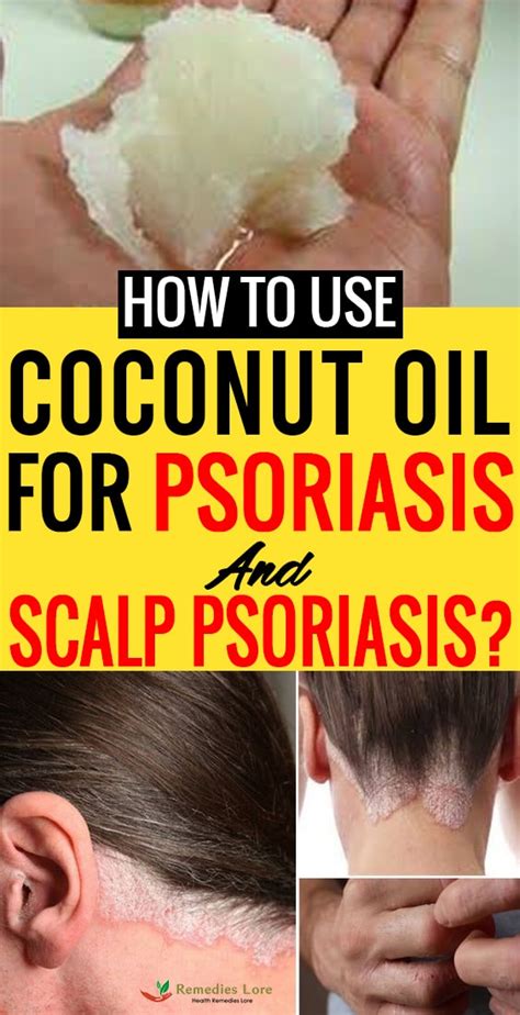 How To Use Coconut Oil For Psoriasis And Scalp Psoriasis Remedies Lore