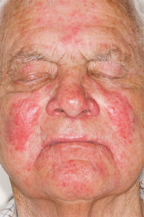 Allergic Skin Reaction To A Drug Photograph By Dr P Marazziscience Photo Library