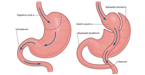 Roux En Y Gastric Bypass