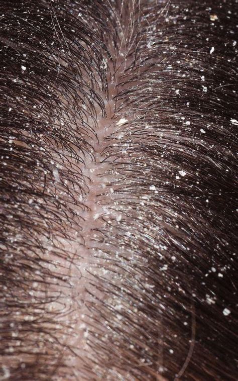 How To Treat Dandruff And Other Scalp Conditions Revitalis
