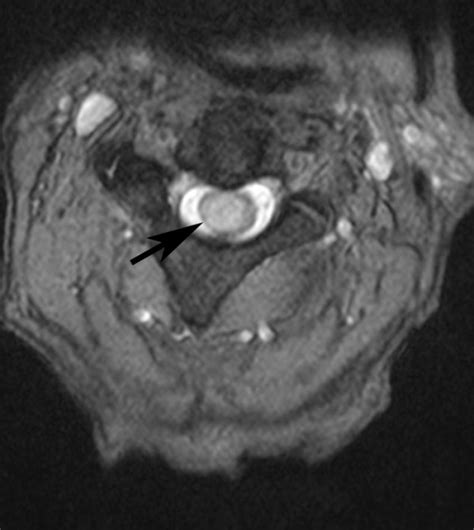 Axial T2 Weighted Mri Of His Cervical Spine Showed That The Lesion Is Slightly To The Right Of