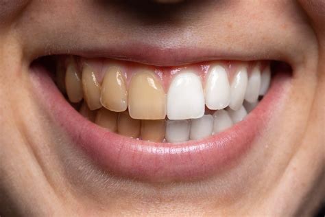 Dents jaunes 5 astuces pour un sourire blanc éclatant Recette et