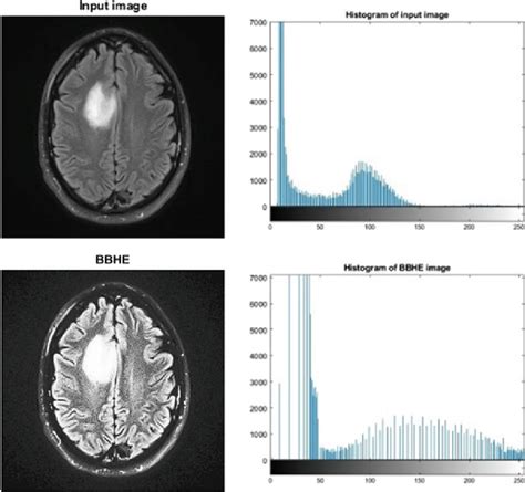 brightness preserving bi histogram equalization for brain tumor download scientific diagram
