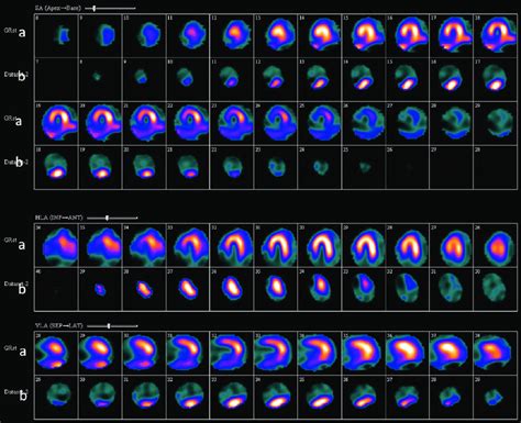 A Myocardial Perfusion Imaging Using Tc 99m MIBI SPECT At Rest In A