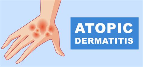 Atopic Dermatitis Causes Symptoms Diagnosis And Treatment Healthinfonetwork