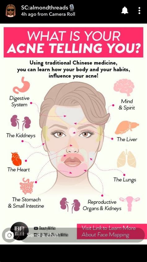 What Is Your Acne Telling You In 2024 Face Mapping Acne Skin Care