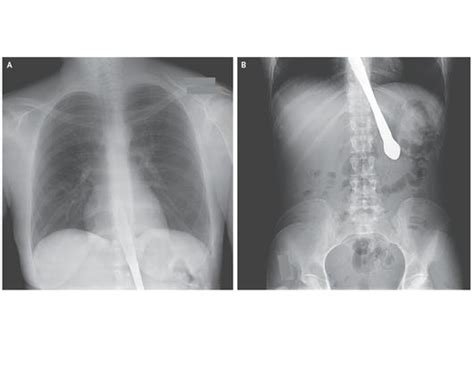 Woman Swallows Butter Knife Picture Unusual X Rays Abc News